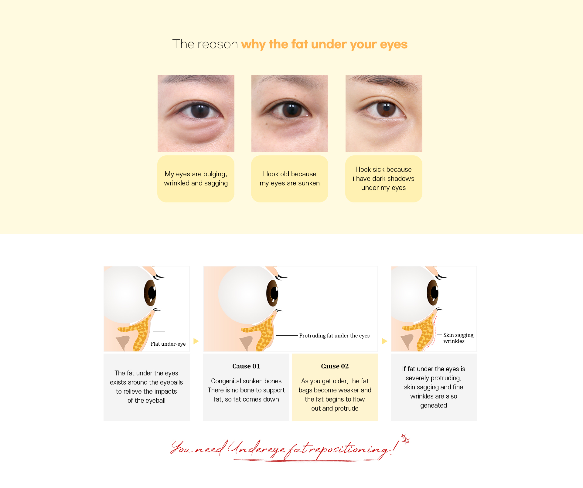 Under-eye Fat Repositioning - Eye Surgery - Byul Plastic Surgery Clinic ...